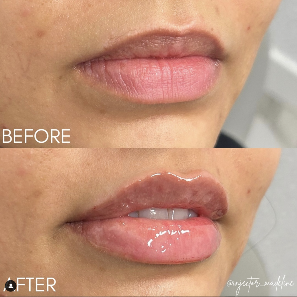 Why Lip Filler is the Go-To Treatment for Natural, Youthful Lips ...