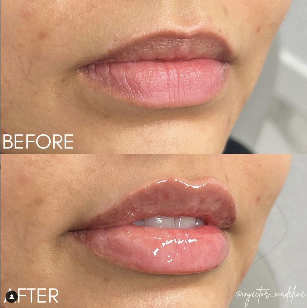 Lip Filler - Mountcastle Medical Spa and Laser Center
