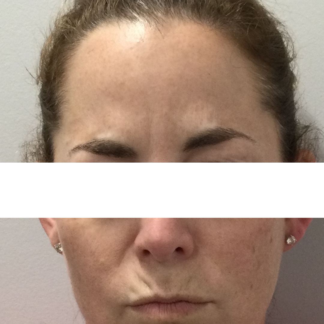 Botox and Dysport – Mountcastle Medical Spa and Laser Center