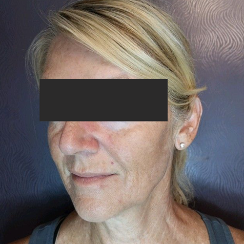 Vivace RF Microneedling Treatment Patient 02 - Mountcastle Medical Spa ...