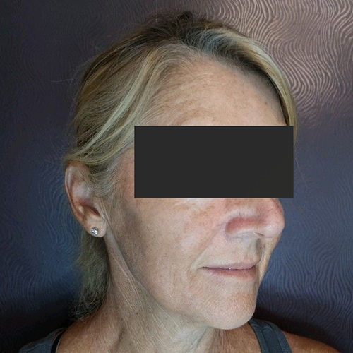 Vivace RF Microneedling Treatment Patient 02 - Mountcastle Medical Spa ...